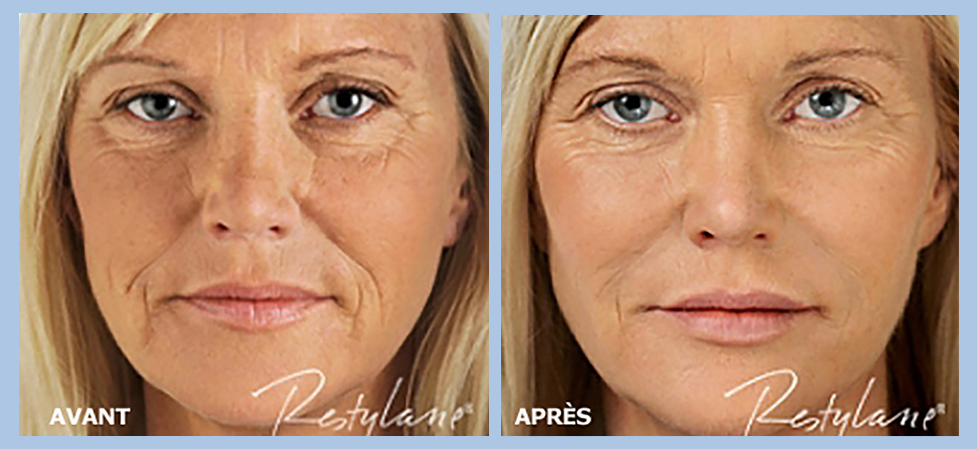 Fillers - Centre de Dermatologie Riviera